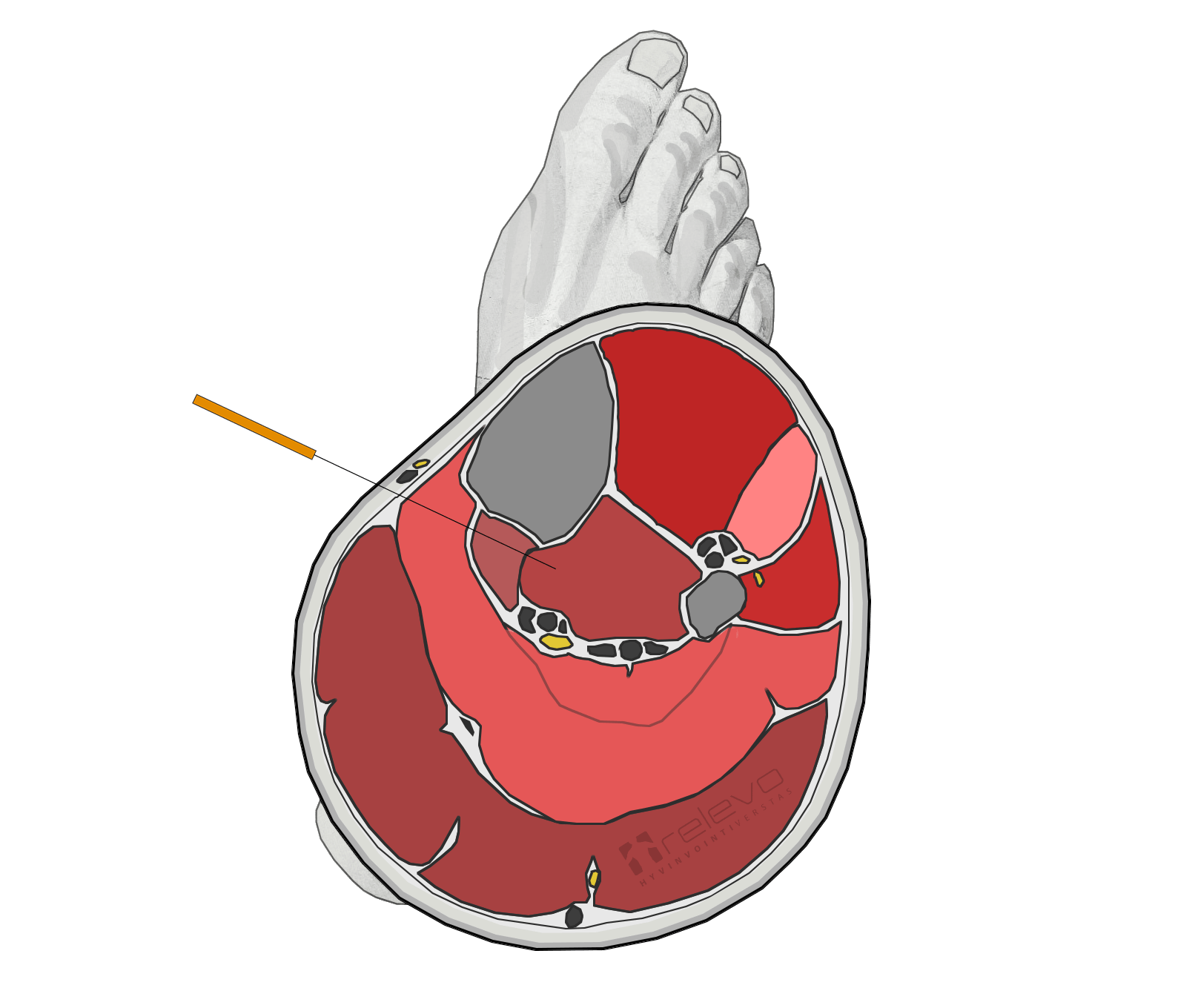 Penikkataudin (syndrooma tibialis medialis) hoitoa - Hyvinvointiverstas ...